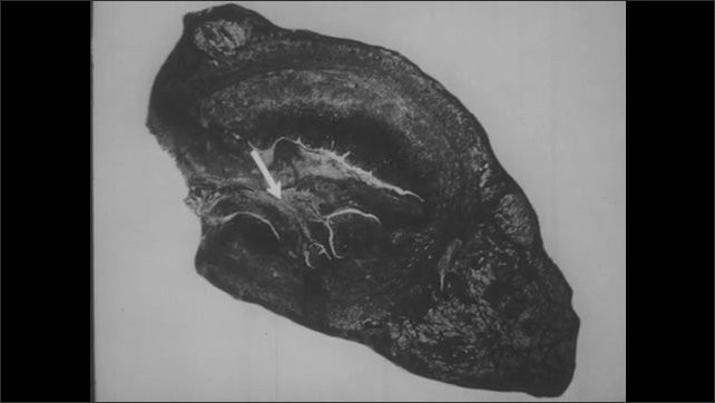 1930s: Cross-Section Of Ruptured Appendix. Arrow Moves Across Appendix ...
