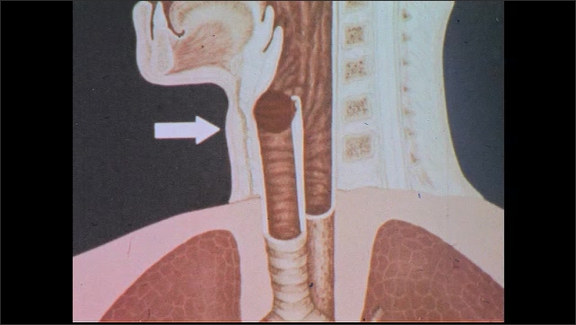 UNITED STATES 1960s: Animation of human body, laryngectomy procedure ...