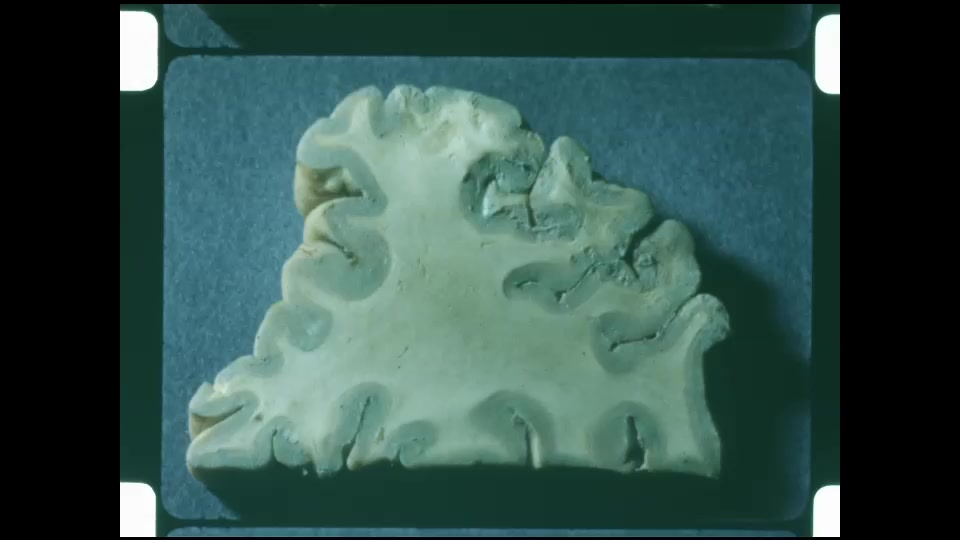 1960s: Parietal lobe brain slice sits on lab table. Tweezer points to ...