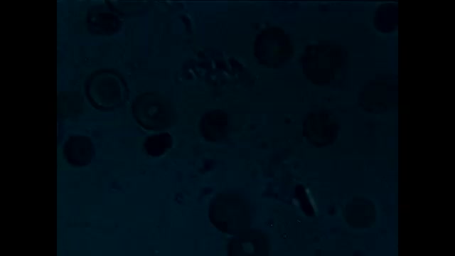 1950s: Microphotography of infected and deformed red blood cells ...