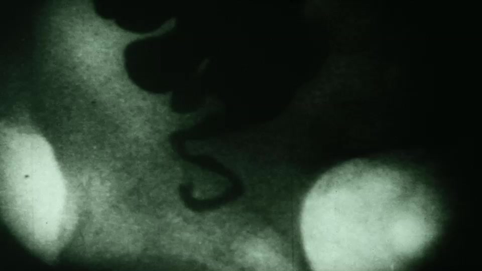 1960s: Radiological x-ray of barium swallow. – Archival Footage