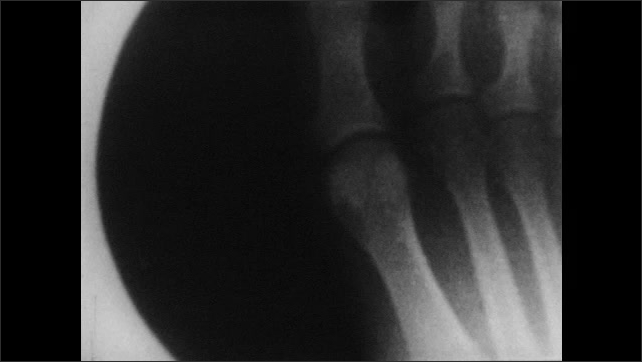 1960s: X-ray movements of feet and toe joints. – Archival Footage