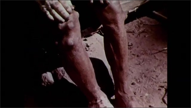 1960s: Boy. Boy looks at lesion on skin. Lesion on skin. Man with ...